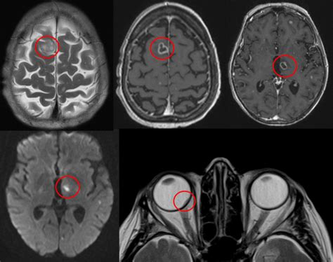 Mri Brain Showing Disseminated Cerebral Nocardiosis And Choroidal Abscess Download Scientific