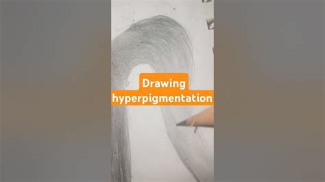 Drawing Hyperpigmentation Youtube