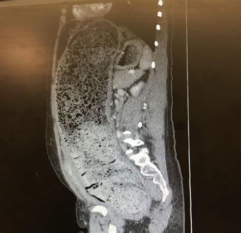 Hepatic Echinococcus Multilocularis In A Dog Shes 6 Mo Out From