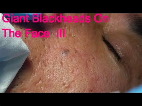Giant Blackhead On Nose Captions Nature