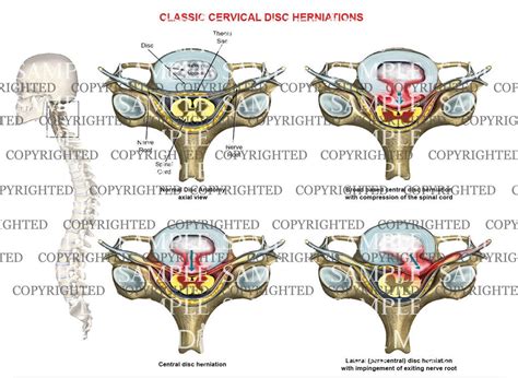 Types Of Disc Herniation