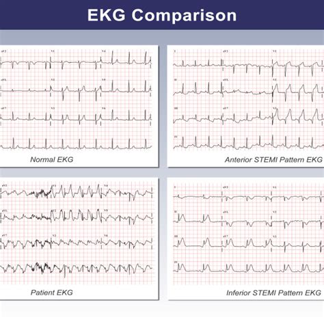Ekg Strips