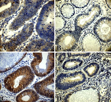 Immunohistochemical Staining Of Cyclin D1 And C Myc In An Lst And A