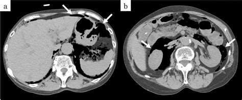 Preoperative Ct Showed A Pneumoperitoneum Arrows And B A Massive