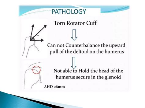 Pathophysiology Of Shoulder Rotator Cuff Instability And Repair Ppt