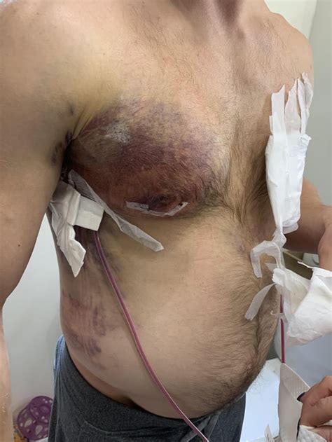 Hematoma From Surgery Rgynecomastia