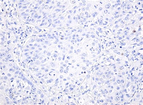 Poorly Differentiated Squamous Cell Carcinoma With A Negative Reaction