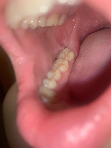 4 Days Post Op Taken Out Nov 8 And Worried Healing Might Not Be Going