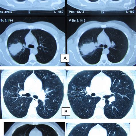 Pdf Fever And Multilobular Mass Of The Right Lung In A Young Adult With Asthma