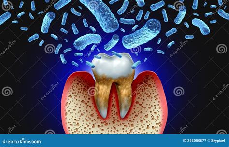 Tooth Bacterial Infection Royalty Free Illustration