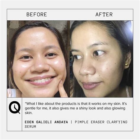 Pimple Eraser Clarifying Serum 30ml Quickfx