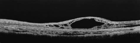 Oct Od Various Cysts In The Macular Area Situated On The Inner Nuclear Download Scientific