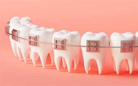 Premium Photo Teeth Brace In The Pink Background 3d Rendering