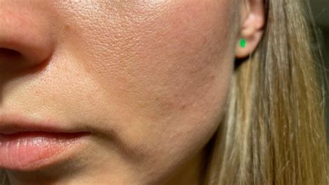 Mješovita Koža Lica Kako Je Prepoznati I Njegovati