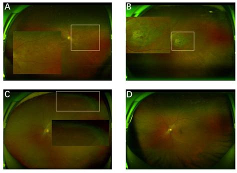 Ultra Wide Field Fundus Images Showing Typical Examples The