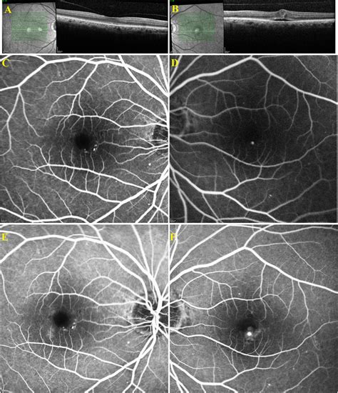 Optical Coherence Tomography Oct Fluorescein Angiography Fa Of The