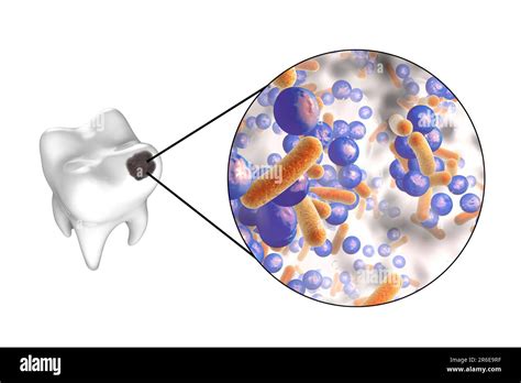 Tooth Decay Computer Artwork Of A Tooth With Cavity And Close Up View