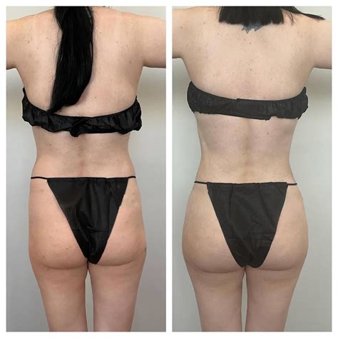 Lymphatic Drainage Massage After Liposuction And Bbl Surgery What You