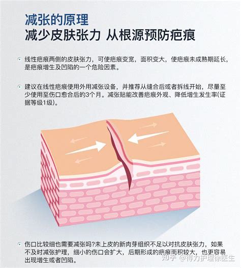 哪种减张贴最好？ 知乎