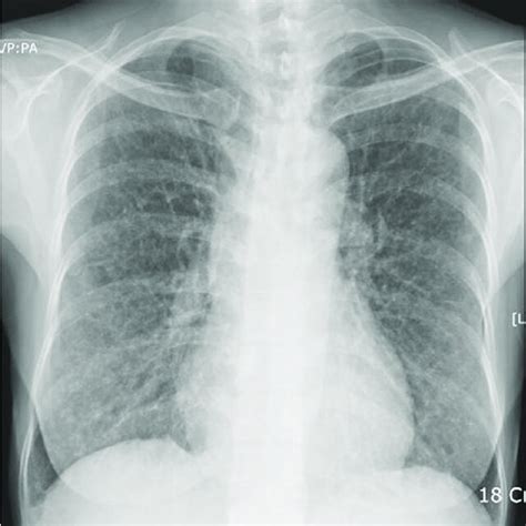 Nodular Pattern Left Vs Reticular Pattern Right On Chest Download Scientific Diagram