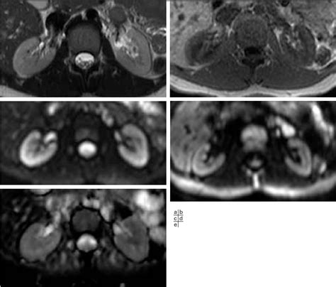 Figure 1 From Apport De Lirm De Diffusion En Pathologie Rénale Semantic Scholar