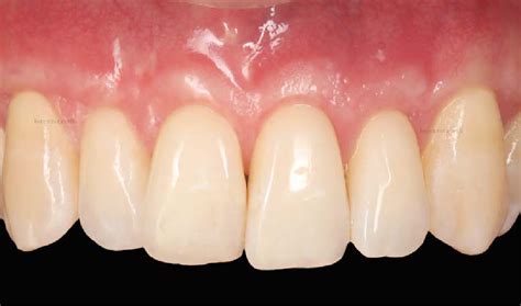 Treatment Of Multiple Gingival Recessions In The Anterior Region Using A 3 Mm Collagen Matrix
