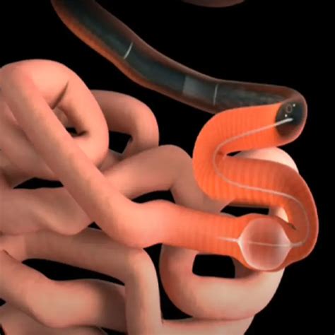 Double Balloon Push Enteroscopy