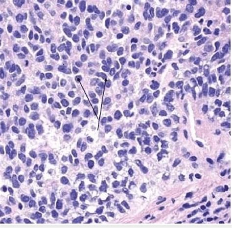 The Tumor Cells Show Small Round Cell Appearance With Focal