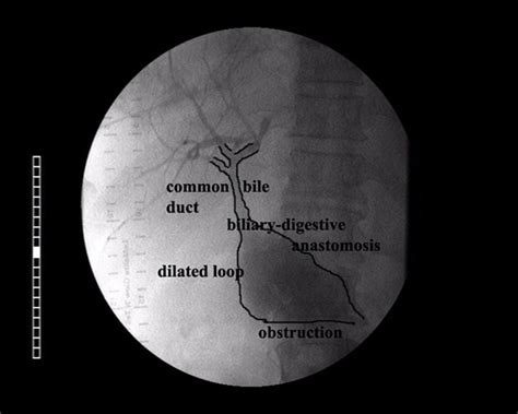 Obstruction Of The Afferent Loop Percutaneous Transhepatic