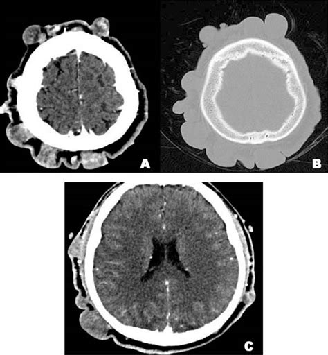 Rbcp Tumor Resection And Partial Skin Graft Placement On The Scalp In A Patient With