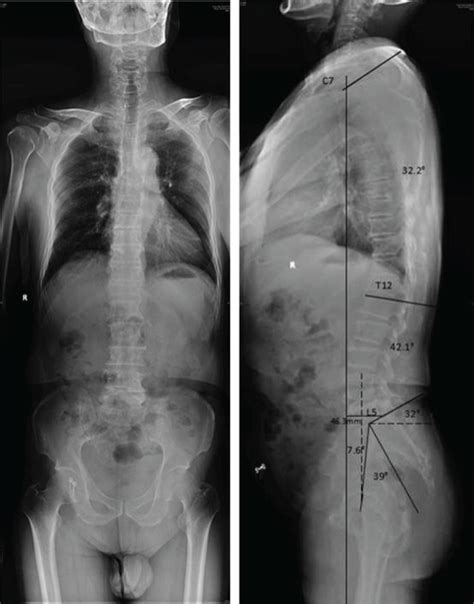 A 67 Year Old Male With Diagnosed With Lumbar Spinal Stenosis And Had Download Scientific