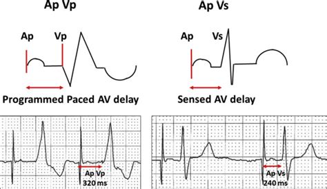 Electrocardiographic Interpretation Of Pacemaker Algorithms Enabling