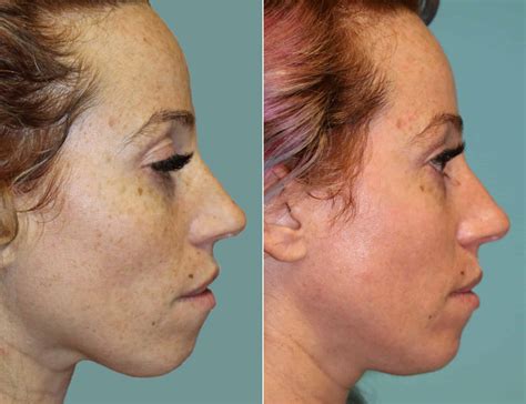 Intense Pulsed Light Therapy Ipl Benefits Cost Naderi Center