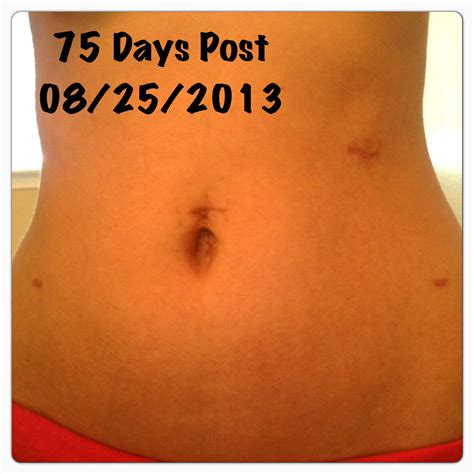 Laparoscopic Hysterectomy Scars