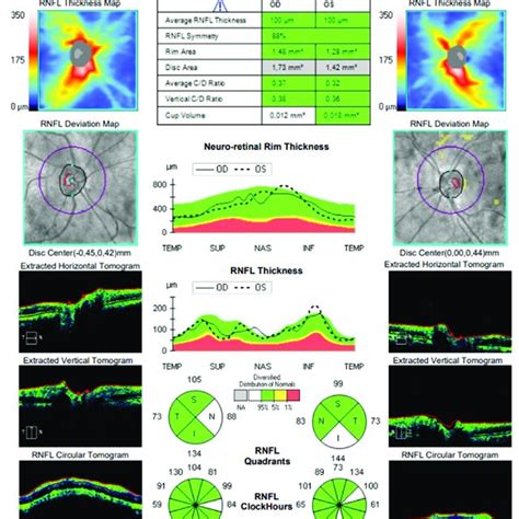 Sd Oct Image Of The Optic Disc Of Both Eyes Sd Oct Image Of The Optic