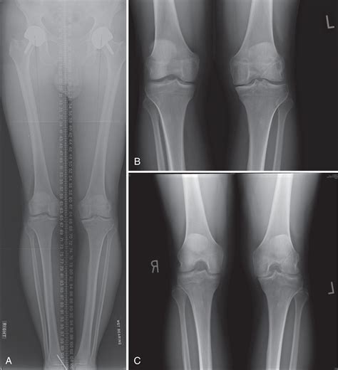 Tibial Osteotomy Clinical Tree