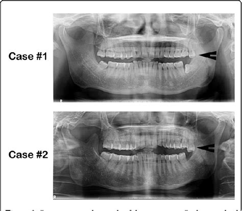 Figure 1 From Impact Of Over Erupted Maxillary Third Molar On Attrition