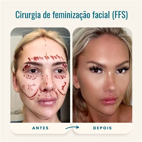Cirurgia De Feminização Facial Ffs Imed Medical
