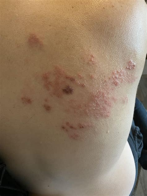 26 With Shingles Never Had It Before But I Went A Couple Days Before Seeing A Doctor And It Was