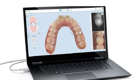 3d Scanning Takes Tooth Impressions In The Dental Field