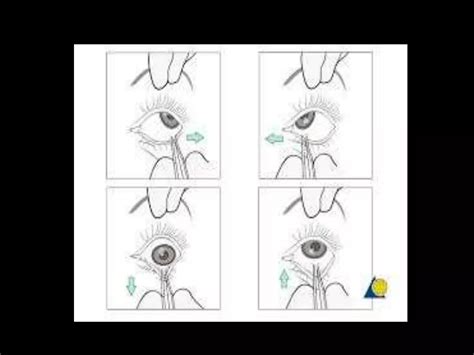 Zygomatic Maxillary Complex Fracture Pptx