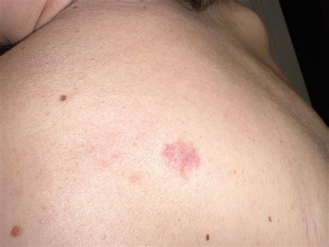 Does This Look Like Ringworm I Just Noticed It Today R