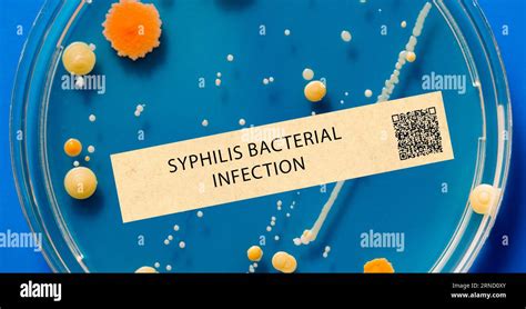 Syphilis Bacterial Infection That Can Cause A Variety Of Symptoms