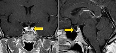 Teaching Neuroimages Sequential Mri Of The Pituitary In Sheehan