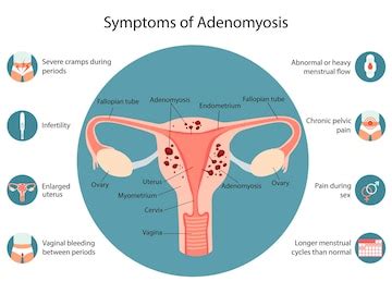 Adenomiosis Síntomas Infografía Vector Detallado Infografía Mujeres