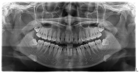 Risk Of Sinus Perforation Rwisdomteeth