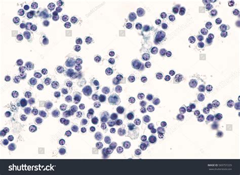 Small Cell Carcinoma Pleural Fluid Cytology Benign Pleural Fluid