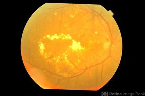 Exudative Diabetic Maculopathy Retina Image Bank