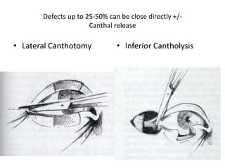 Upper Eyelid Reconstruction Pptx