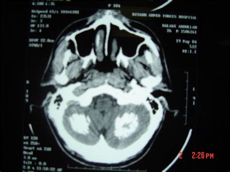 Ct Brain Revealed Extension Of Calcification To Cerebellum Download